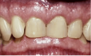 Malocclusion Severity Index - Bernstein Orthodontics