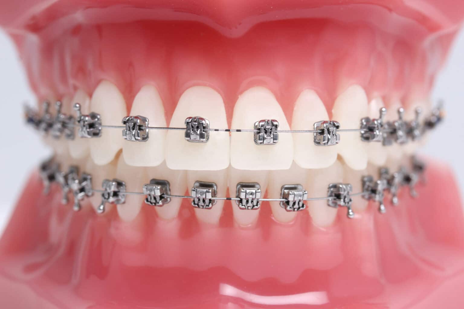 Self-Ligating Clear Braces | Braces Santa Rosa | Dr. Bernstein