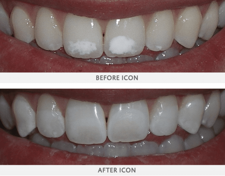 Cosmetic Dental Procedures - Bernstein Orthodontics - Windsor Ortho