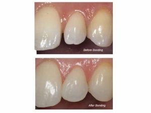 Cosmetic Dental Procedures - Bernstein Orthodontics - Windsor Ortho