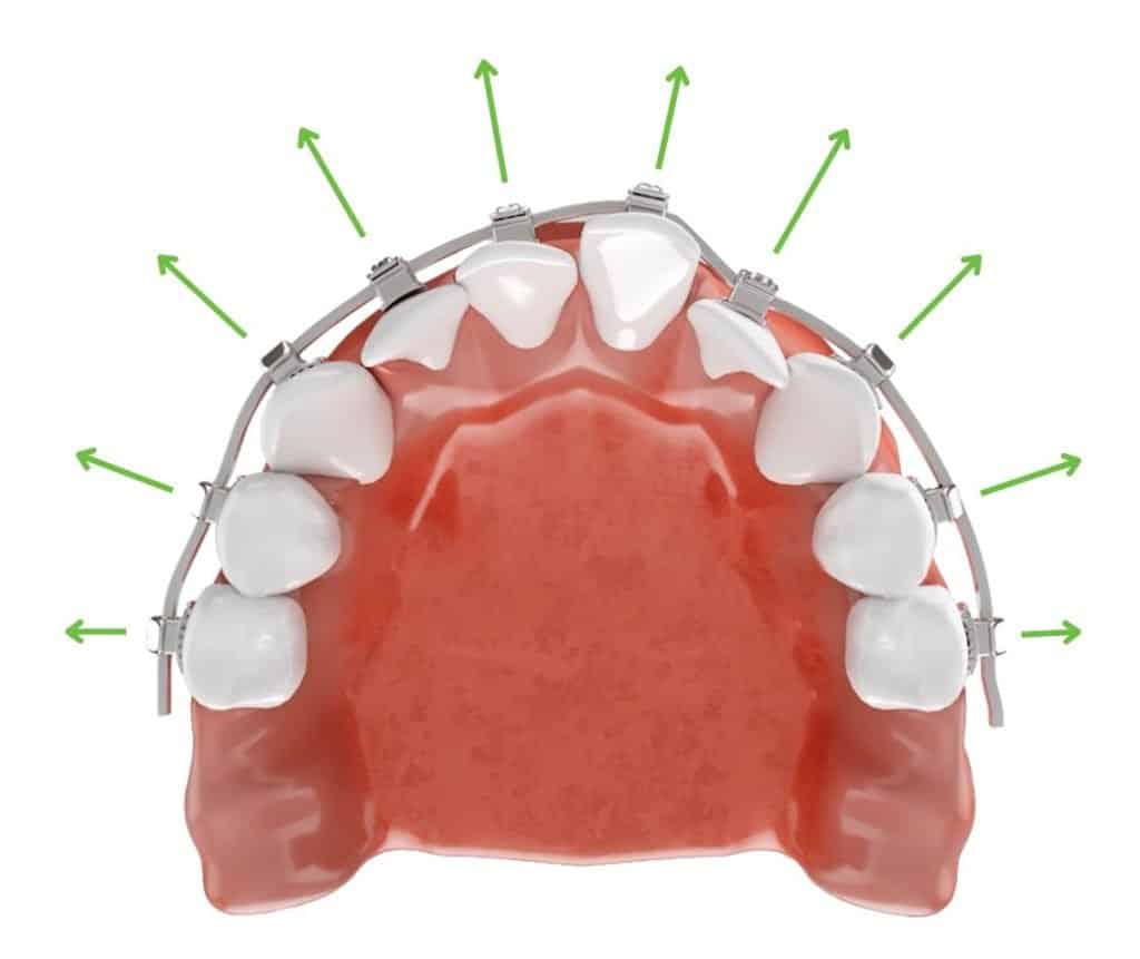 Children’s Orthodontics - Bernstein Orthodontics - Treatment