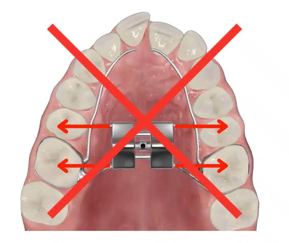Children’s Orthodontics - Bernstein Orthodontics - Treatment