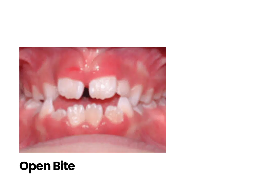 Children’s Orthodontics - Bernstein Orthodontics - Treatment