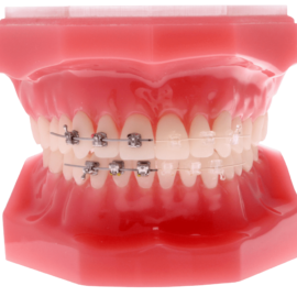 Clear Braces - Bernstein Orthodontics - Santa Rosa Orthodontics